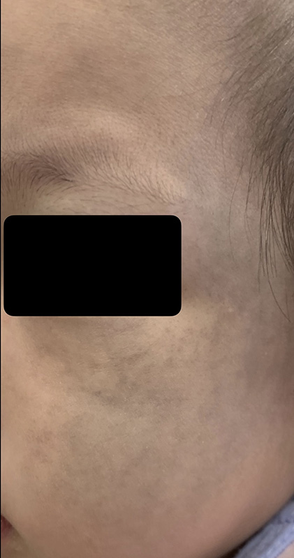 Nevus of Ota - Ark Dermatology