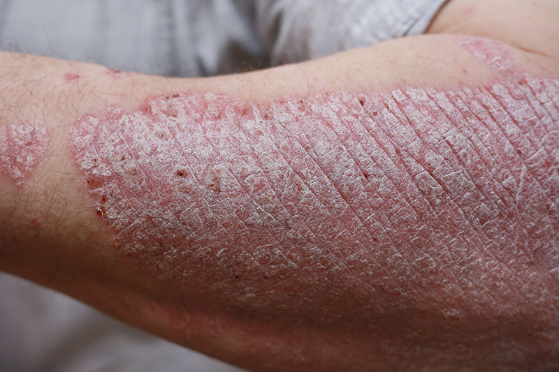 Psoriasis - Ark Dermatology