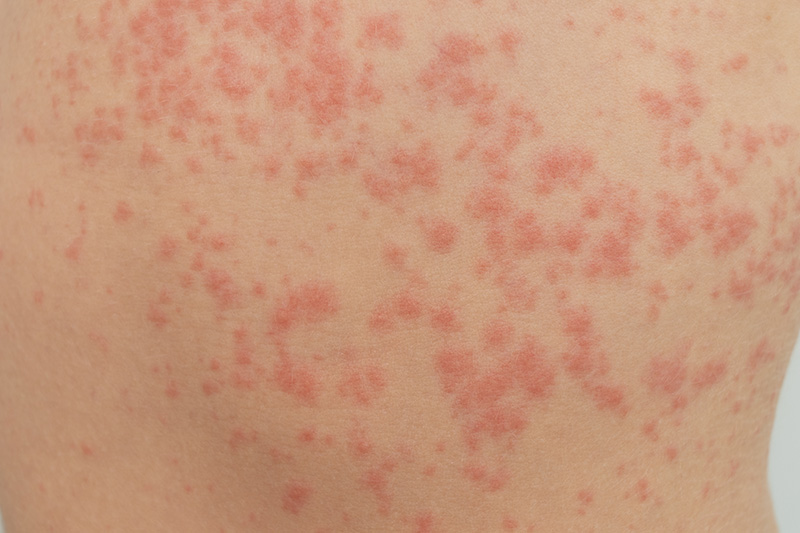 Urticaria - Ark Dermatology